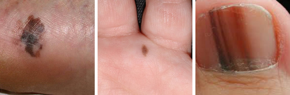 Acral Lentiginous Melanoma Palm