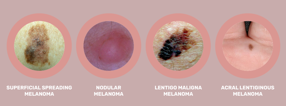 Superficial Spreading Melanoma Foot