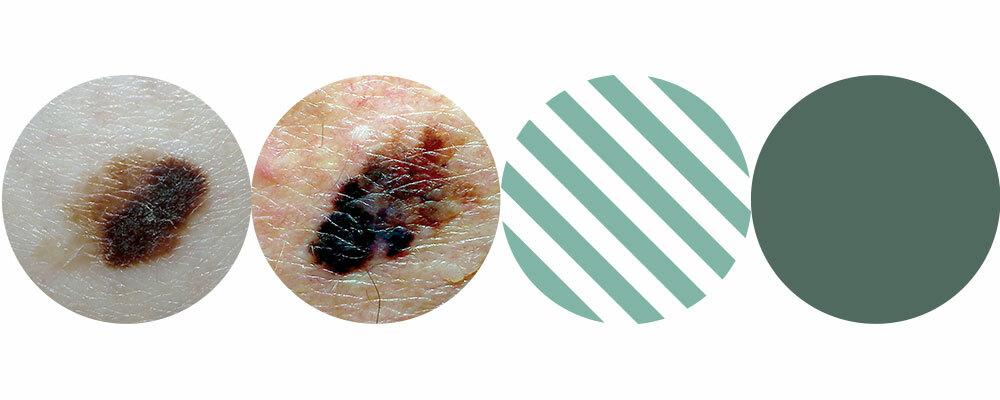 molemap-website | MoleMap Australia