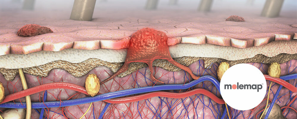 Skin Cancer Types