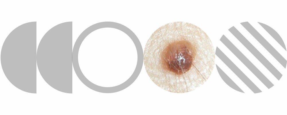 Worried About Moles? Explore Our Mole guide to Spotting Skin Cancer ...