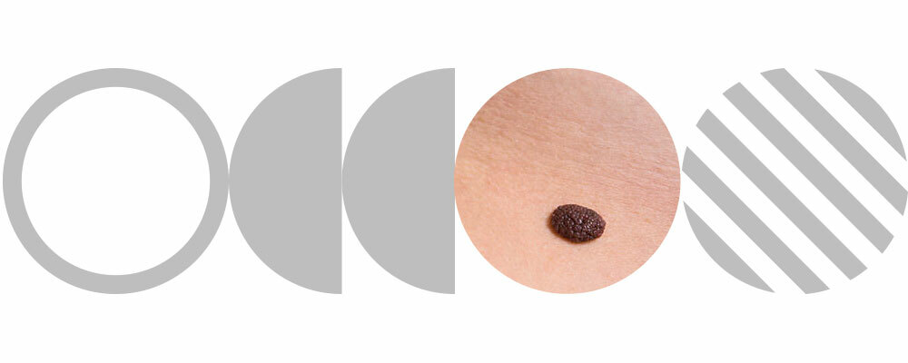 Worried About Moles? Explore Our Mole guide to Spotting Skin Cancer ...