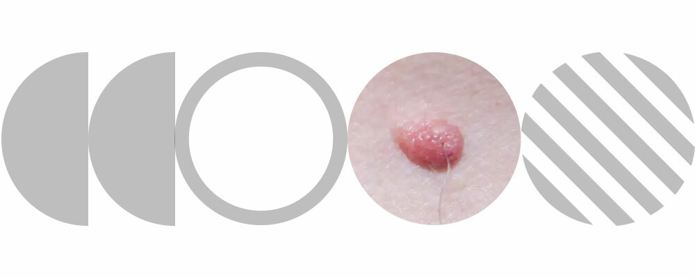 Different Types Of Moles Moles NHS