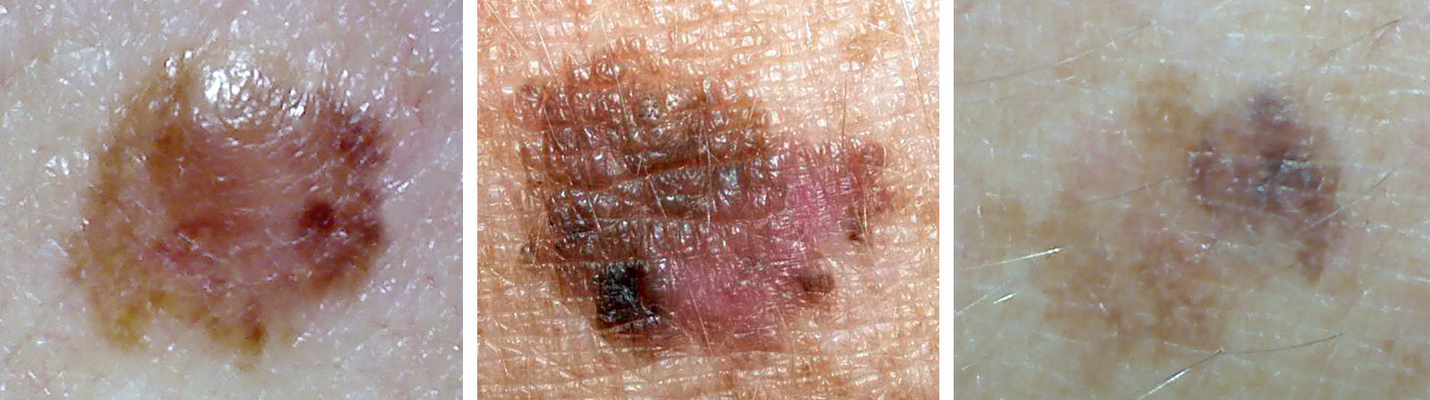 How Do I Know If It's Melanoma? - Molemap Australia