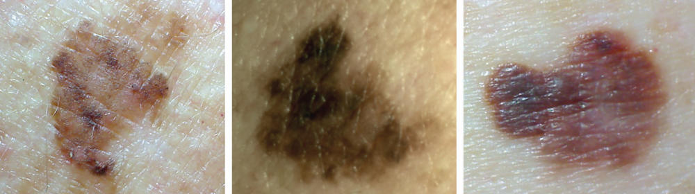 How do I know if it's melanoma? - MoleMap