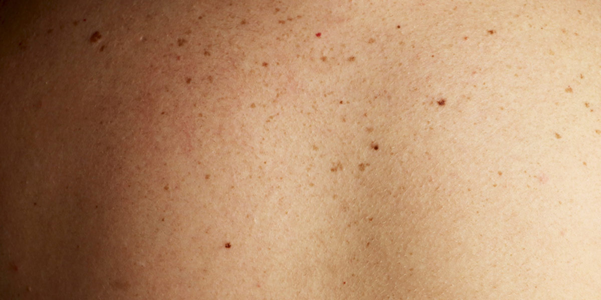 Early Stage Skin Cancer Medical Pictures Info – Lepromatous Leprosy