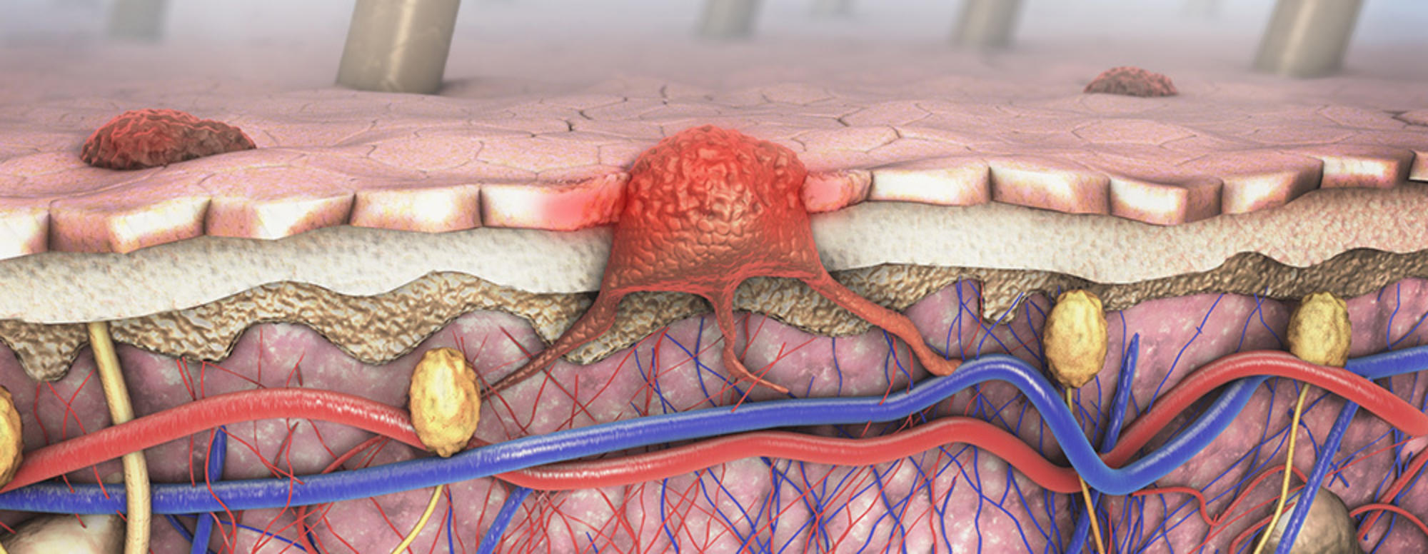 11 skin cancer symptoms you should never ignore | MoleMap NZ Official Site