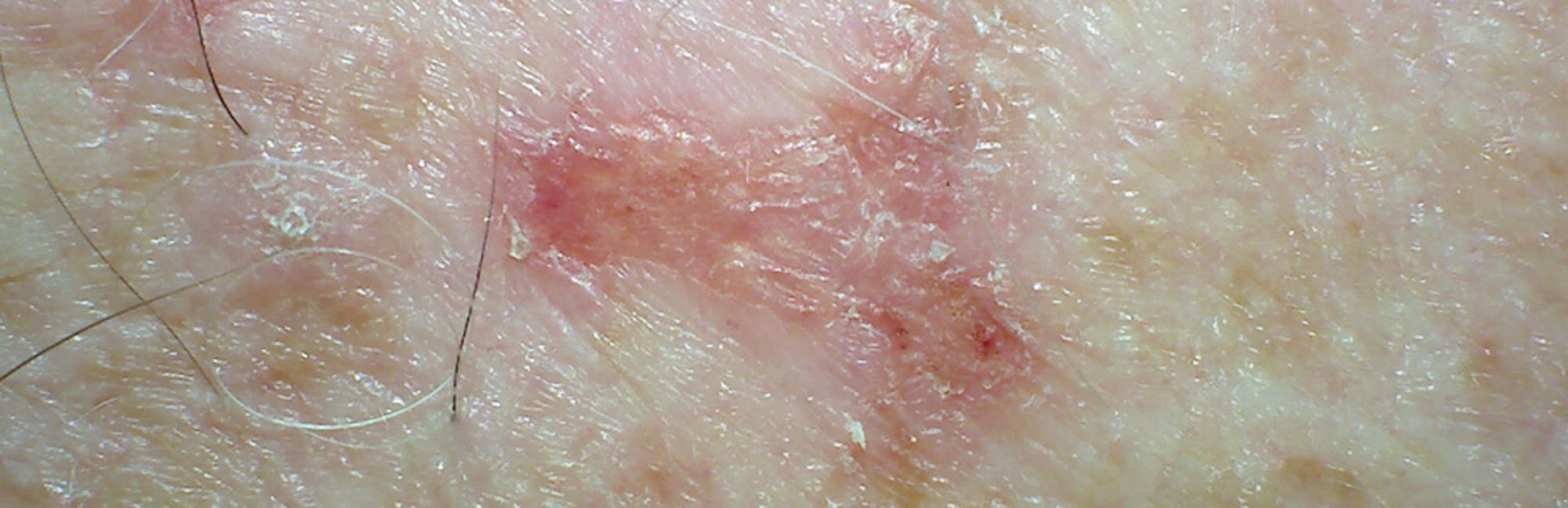 Signs Of Skin Cancer Scaly Patches at Helen Mckenzie blog